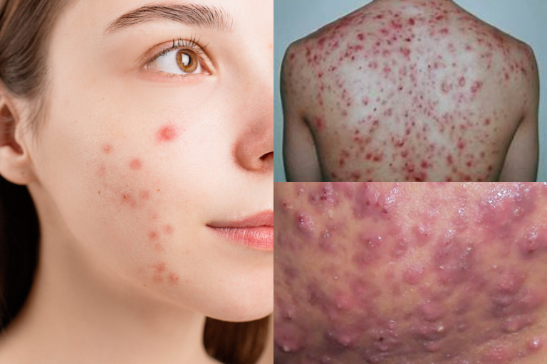 Acne: conheça os 5 graus da doença e suas causas - Fala! Universidades
